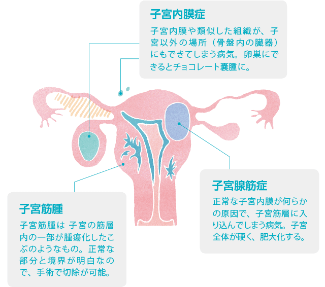 「ゴナールエフ ®」│【医師監修】ジネコ不妊治療情報
